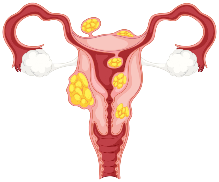 Fibroids Female Care Package - GreenWorld Gresswold